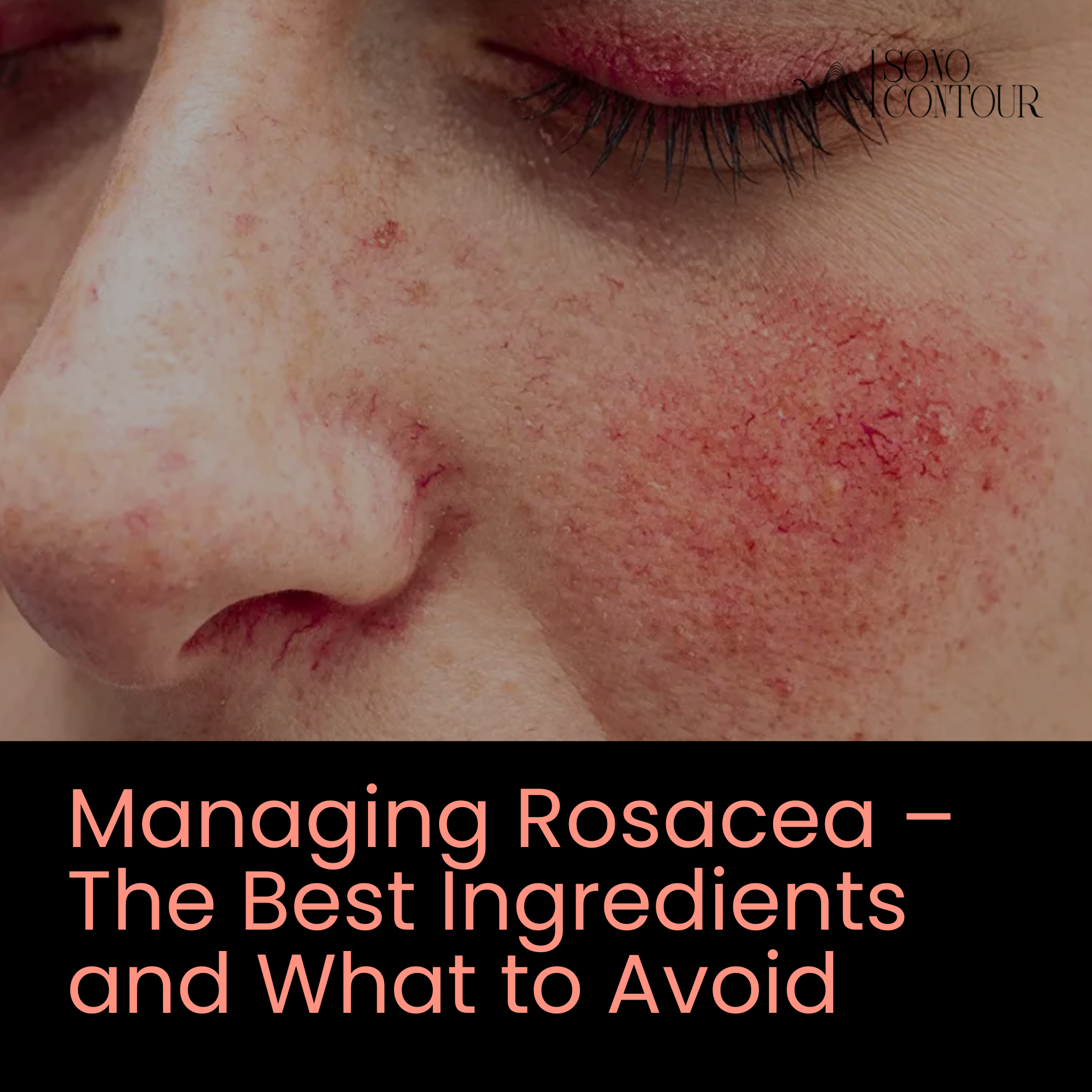 Managing Rosacea – The Best Ingredients and What to Avoid – sonocontouring